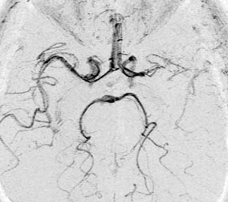 Neuroradiology Reading Room: MRA ax