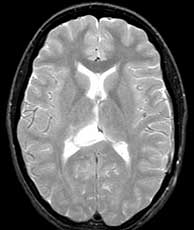 Neuroradiology Reading Room: T2 ax