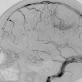 Neuroradiology Reading Room: Lat ECA TITLE ICA angio