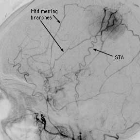 Neuroradiology Reading Room: Lat ECA TITLE ICA angio