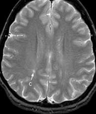 Neuroradiology Reading Room: T2 ax